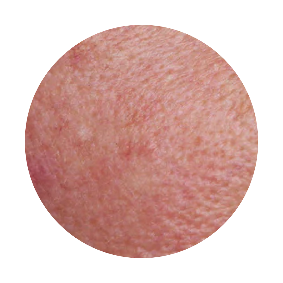 Menopausal Skin